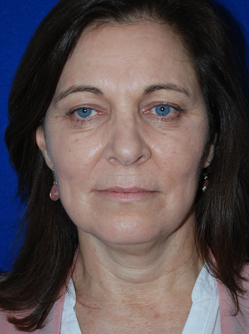 Facelift Before and After | Plastic Surgery Institute of Washington