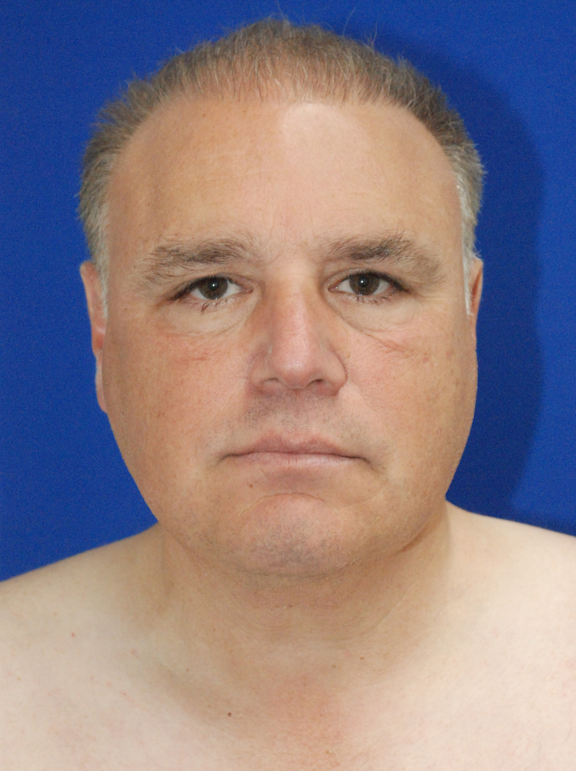 Facelift Before and After | Plastic Surgery Institute of Washington