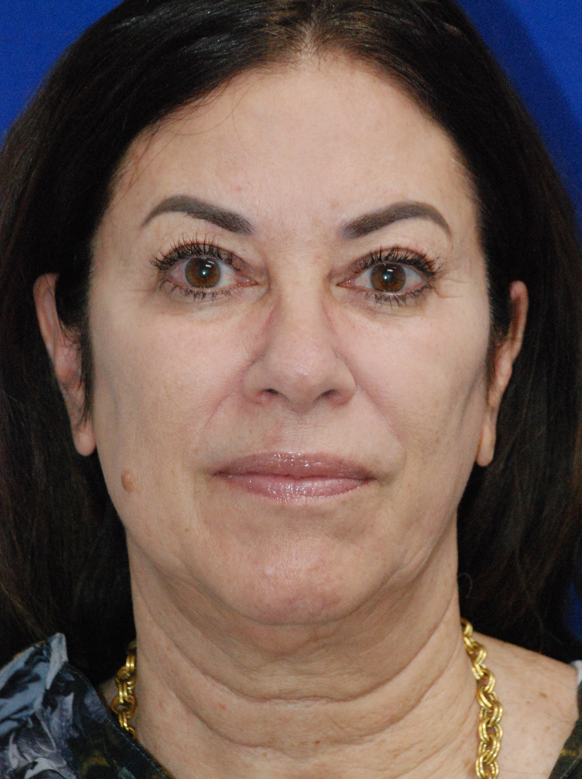 Facelift Before and After | Plastic Surgery Institute of Washington